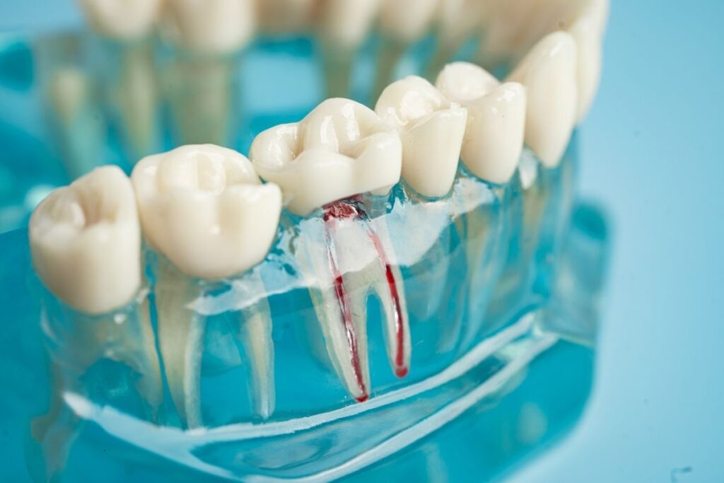 How Long Does a Root Canal Last?