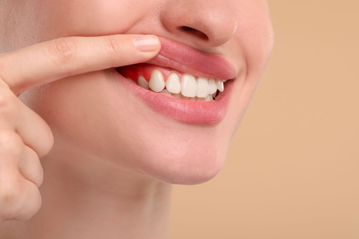 Stages of Tooth Enamel Erosion: From Mild to Severe